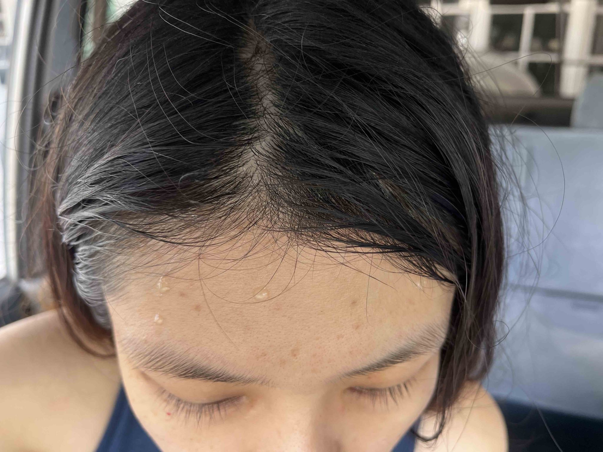 Hyperhidrosis on the Scalp - PUCHONG-IAN 蒲种人